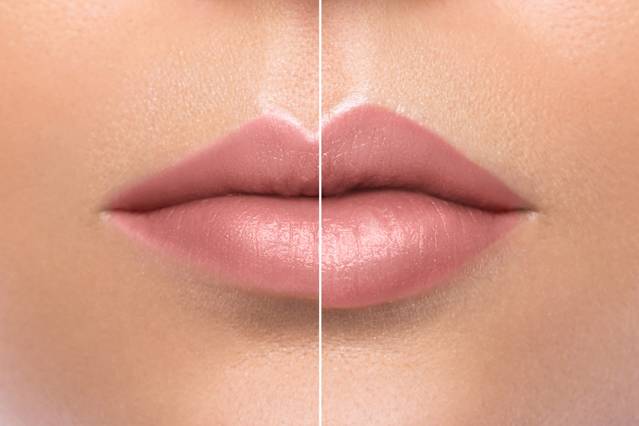 Lip Augmentation – Dr Melissa Clinic